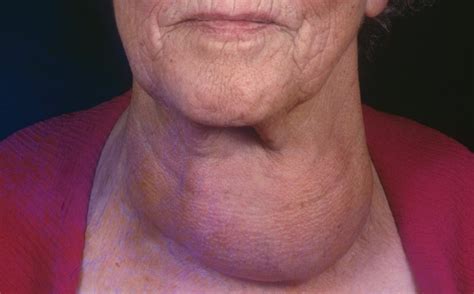 Example Of A Goiter Diagram Quizlet