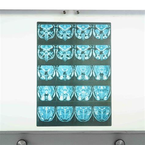 X Ray Ct Scan Film Medical