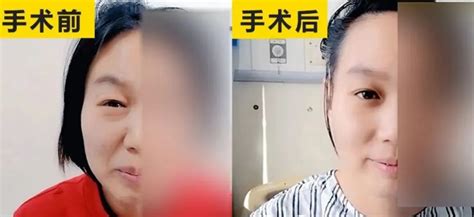 得了面肌痉挛为什么你的眼睛会越来越丑 姜海涛主任医师 爱问医生
