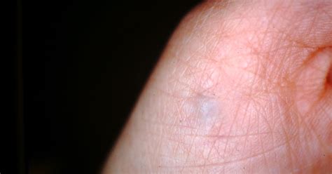 Angioleiomyoma Definition Symptoms Causes Treatment