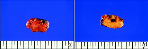 Macroscopic Findings Of The Excised Lymph Node A The Exterior Of The Download Scientific