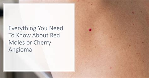 Red Moles Cherry Angioma Causes And Treatment Options