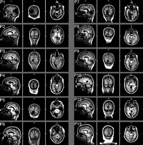 Anatomical Scans Of The Subjects In Radiological Convention Lr Rl Download Scientific
