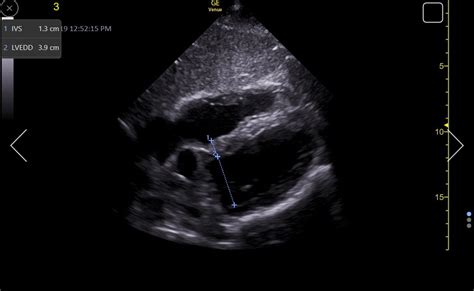 What Are Lv Measurements Semashow