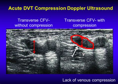 Chapter 25 Venous Duplex Imaging Flashcards Quizlet