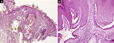 Recalcitrant Vegetative And Nodular Scalp Lesions On The Vertex In