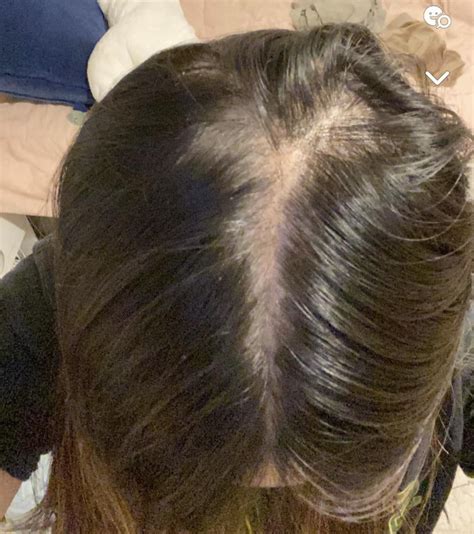 Could This Be Androgenic Diffuse Diffuse Is Biopsy Confirmed R