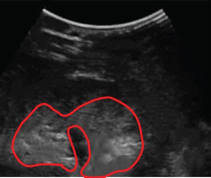 Comparison Of Ultrasonic Image Segmentation A Denoised Image B Download Scientific