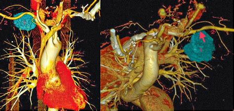 A B 3d Reconstruction Of The Tumor Of The Apical Segment Of The Right
