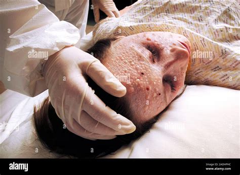 Model Released Smallpox Infection Simulation Of A Doctor Stroking The