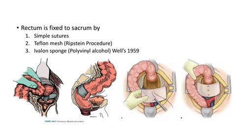 Rectal Prolapse Pdf Digestive Disorders Diseases And Conditions