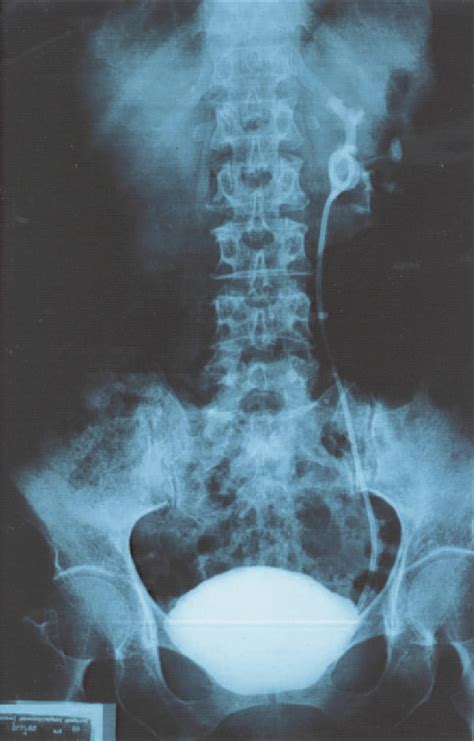 Retrograde Cystography In A Patient Who Received An Internal Ureteral