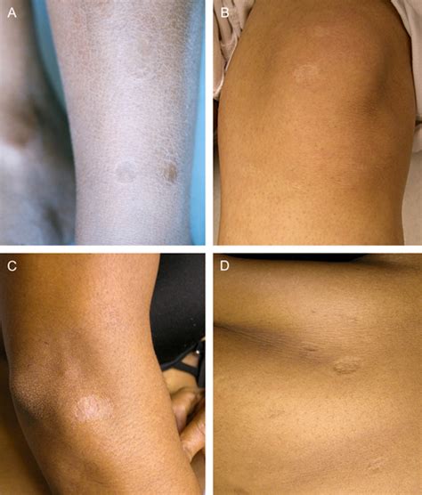 Follicular Atrophoderma