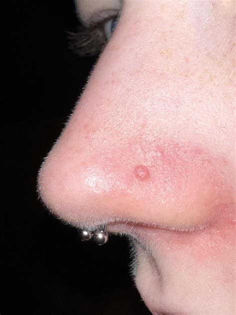 Will My Piercing Bump Dissapear R Piercingadvice