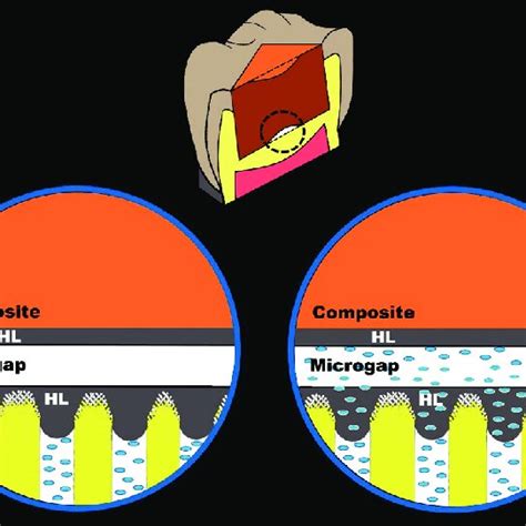 Dentinal Fluid Shifting Into The Gap Formed At Pulpal Floor The Fluid