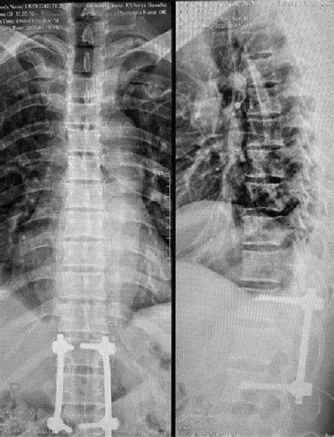 Ap And Lateral Postoperative View Of The Thoracolumbar Spine Shows