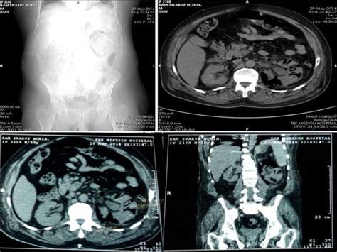Emphysematous Pyelonephritis Case Discussion Pptx
