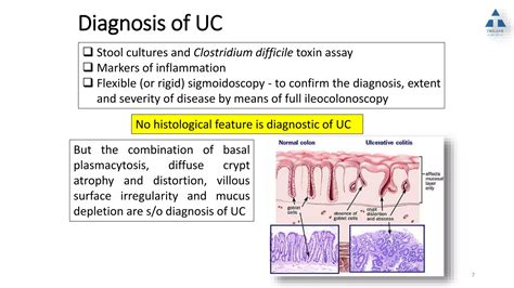 Ulcerative Colitis Protocol Presentation Pptx