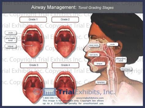 Tonsil Grading Chart