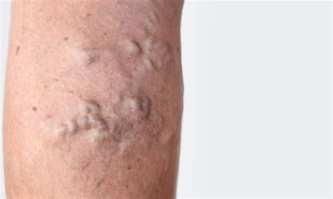 Vene Gonfie Sulle Mani Francesco Collarino