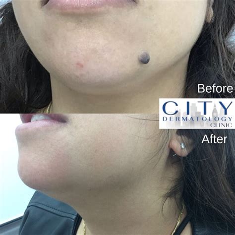 Mole Removals Scarring Healing And What To Expect Zherss