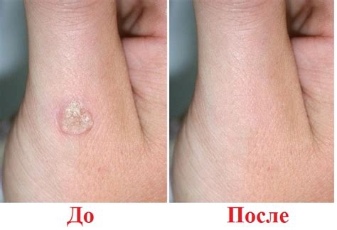 Удаление бородавок лазером удалить бородавку в СПб