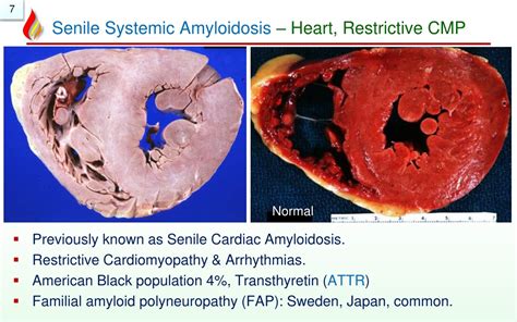 Ppt Amyloidosis Powerpoint Presentation Free Download Id8201967