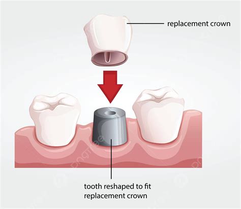 Dental Crown Procedure Teeth Replacement Implant Vector Teeth