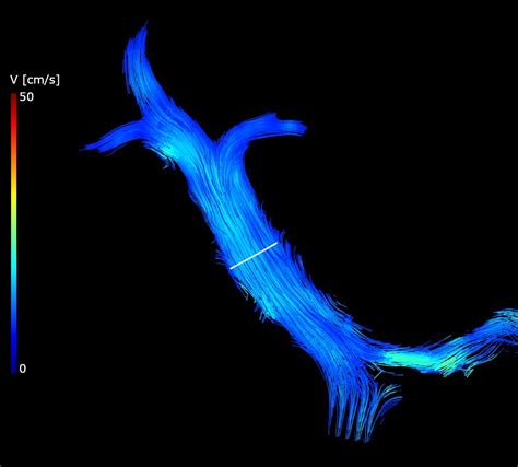 4d Flow Mri Shows Promise In Chronic Liver Disease Auntminnieeurope
