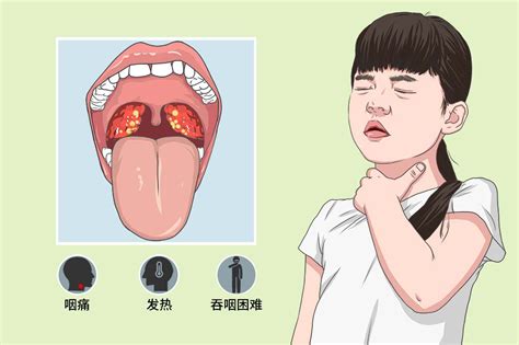 小儿化脓性扁桃体炎 有来医生