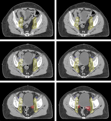 Pelvic Lymph Nodes Location Imaging Of Pelvic Lymph Nodes Ryuc
