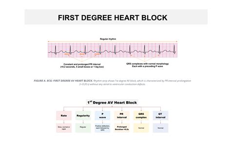 How To Read An Ecg Ecg Interpretation Reading Heart Blocks 12 Lead Ekg