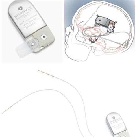 Deep Brain Stimulator Dbs The Left Images Show The Stimulator Download Scientific Diagram