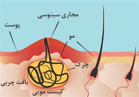 کیست مویی چیست؟ علائم، دلایل و درمان مقاله آرتا پیشرو