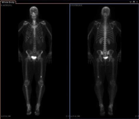 Low Dose High Quality SPECT CT Imaging Transforms Patient Care Applied Radiology