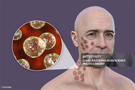 Cutaneous Blastomycosis 3d Illustration High Res Vector Graphic Getty