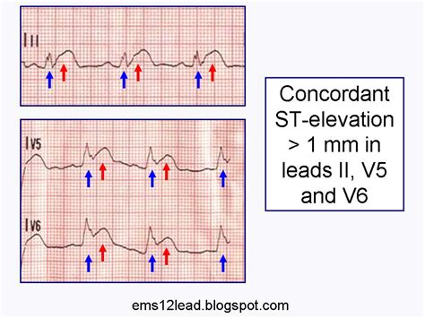 58 Year Old Female CC Chest Pain Conclusion Paramedicine 101