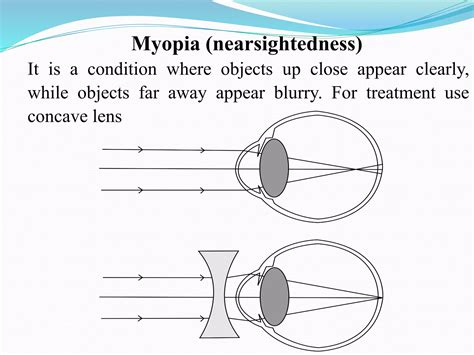 Refractive Error PDF Eye And Vision Conditions Diseases And Conditions
