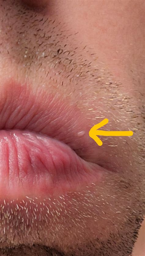 What Is This Bump On My Lip R Dermatologyquestions