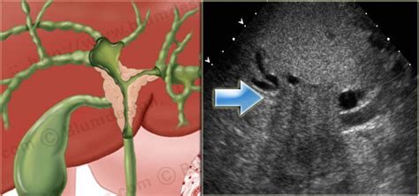 The Radiology Assistant Biliary Duct Pathology