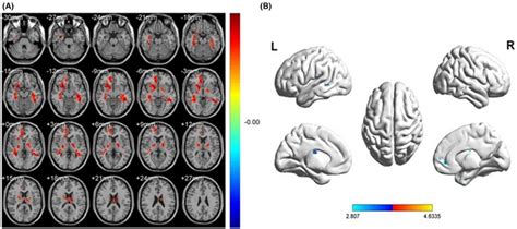 Spontaneous Brain Activities In Pm And Hcs Note The Blue Areas