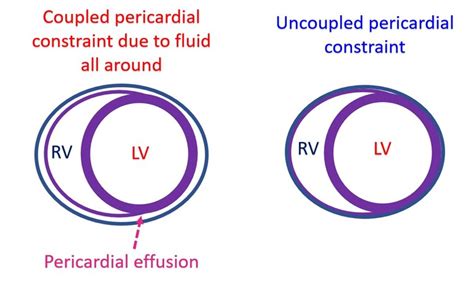 Concept Of Coupled And Uncoupled Pericardial Constraint All About Cardiovascular System And
