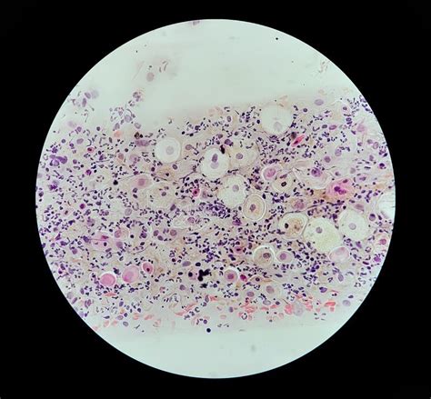 Photomicrograph Of Paps Smear Inflammatory Smear With Vaginal