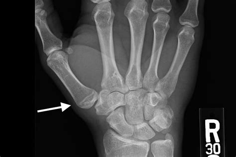 Thumb Metacarpal Fractures Hand Surgery Resource