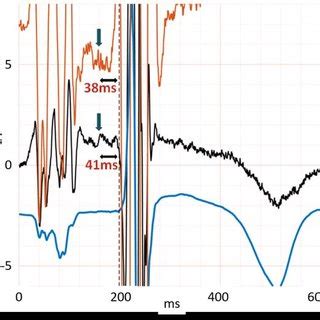 This Figure Shows Patient 25 Filtered Bipolar Signal 3 Orange Signal Download Scientific