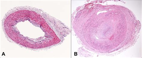 Advances In Diagnosing And Treating Giant Cell Arteritis New Hope For
