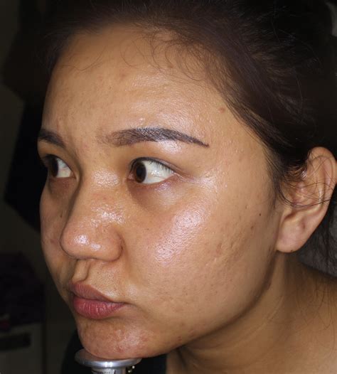 Acne Object Detection Dataset By New Workspace Ii6dw
