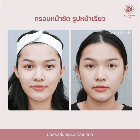 ฉีดโบ คือ ทำไมถึงนิยมฉีด ช่วยเรื่องอะไรบ้าง พร้อมวิธีเช็ค โบ แท้