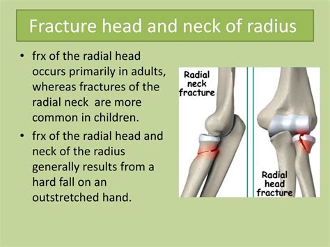 Ppt Common Upper Limb Fractures Powerpoint Presentation Free