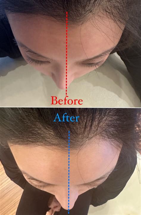 신용산필라테스 얼굴and턱비대칭 교정 전후 네이버 블로그